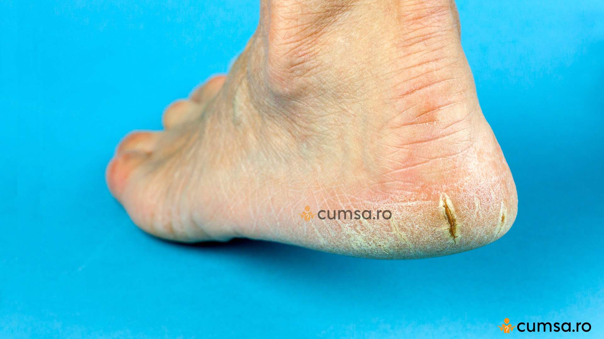 Cum sa scapi de calcaie crapate si uscate. Remedii naturale - cumsa.ro