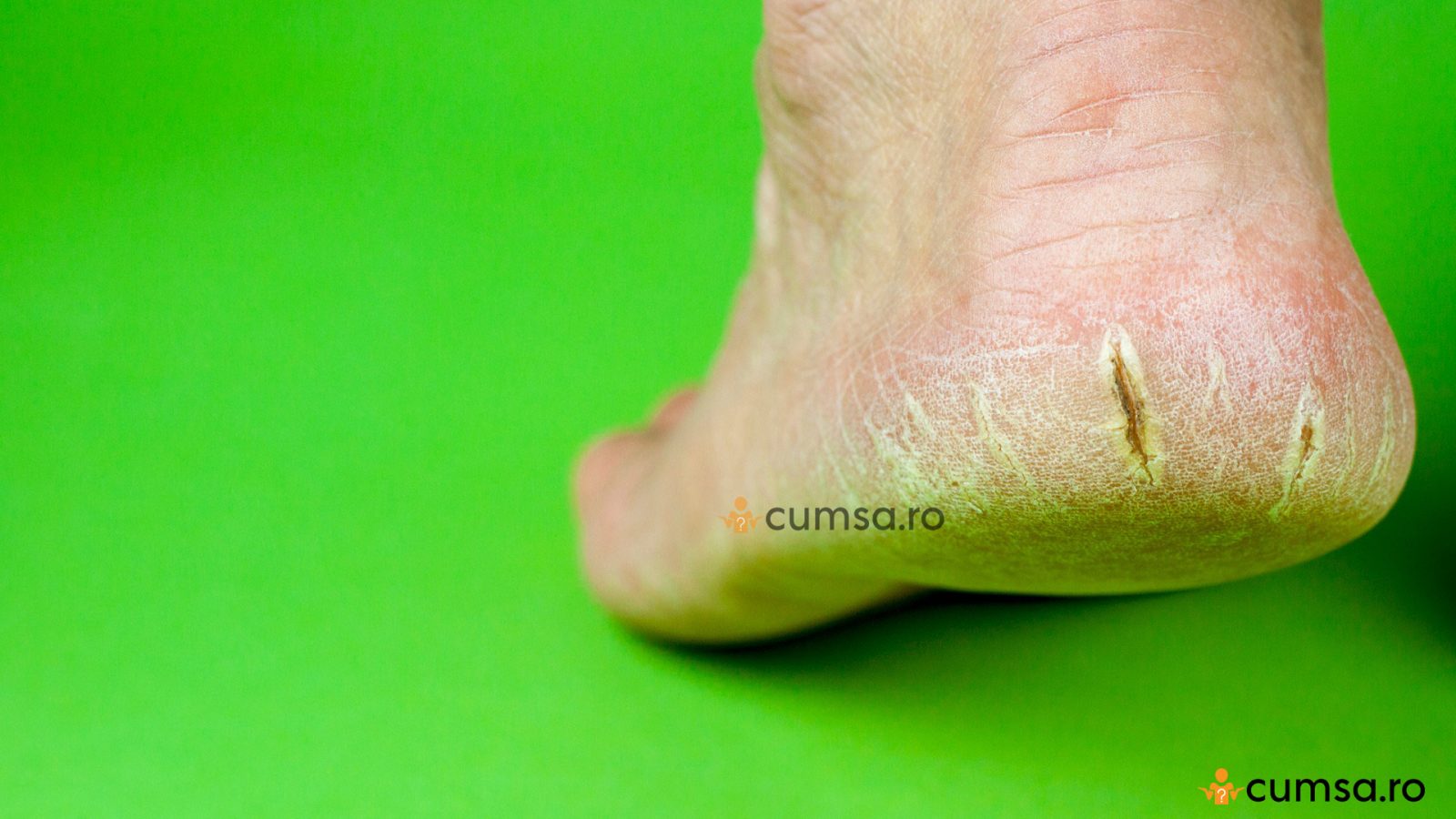 Cum sa scapi de calcaie crapate si uscate. Remedii naturale - cumsa.ro