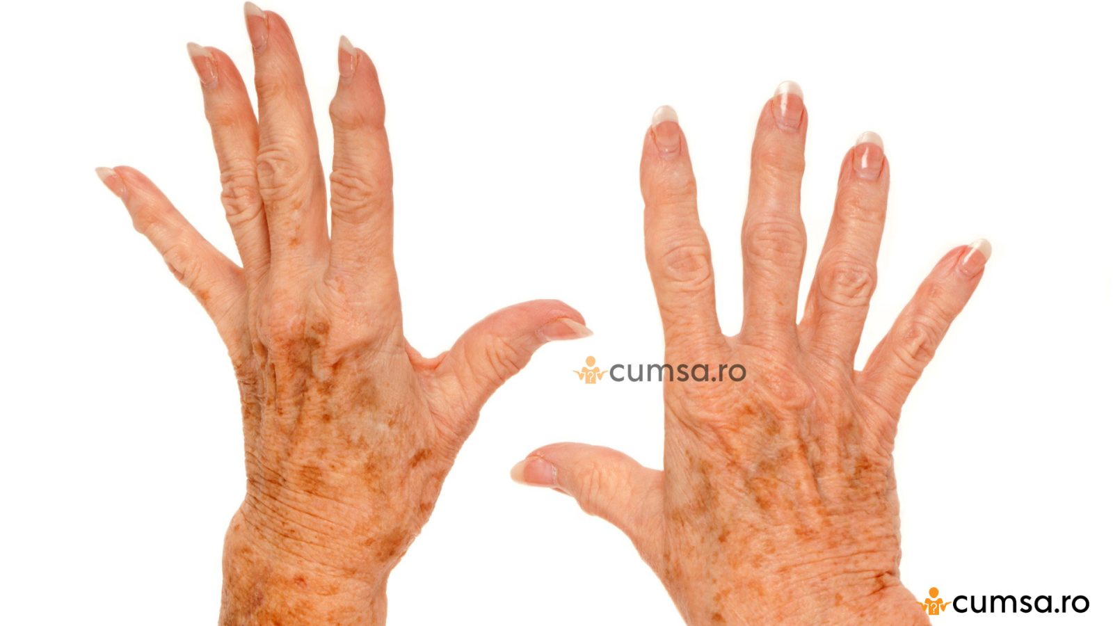 Pete maronii pe maini. Cum sa scapi de acestea cu remedii naturale ...