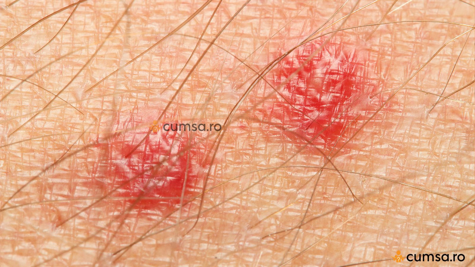 Muscaturi de plosnite. Cum sa le identifici si cum le tratezi - cumsa.ro