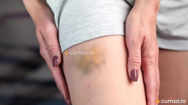 Cum sa scapi de vanatai. Remedii naturale - cumsa.ro